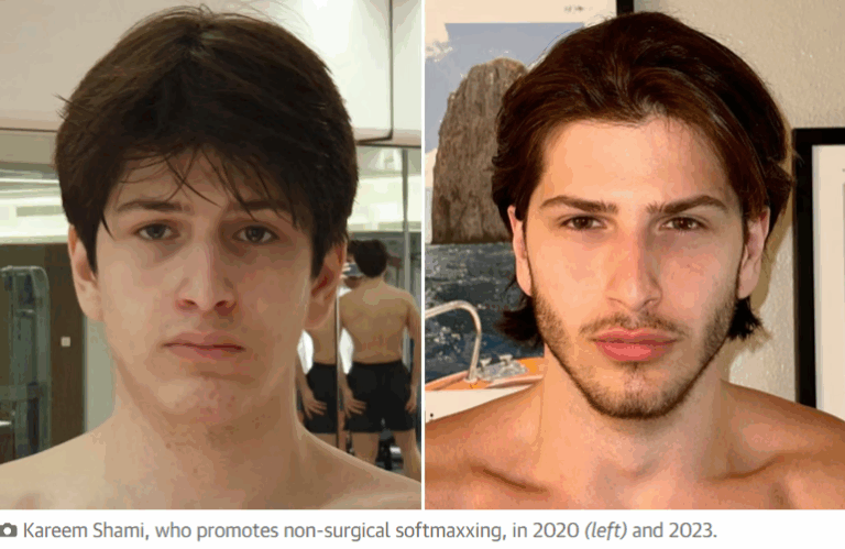 Influencer who got on TRT at 14 also does “bone smashing” to make his ...